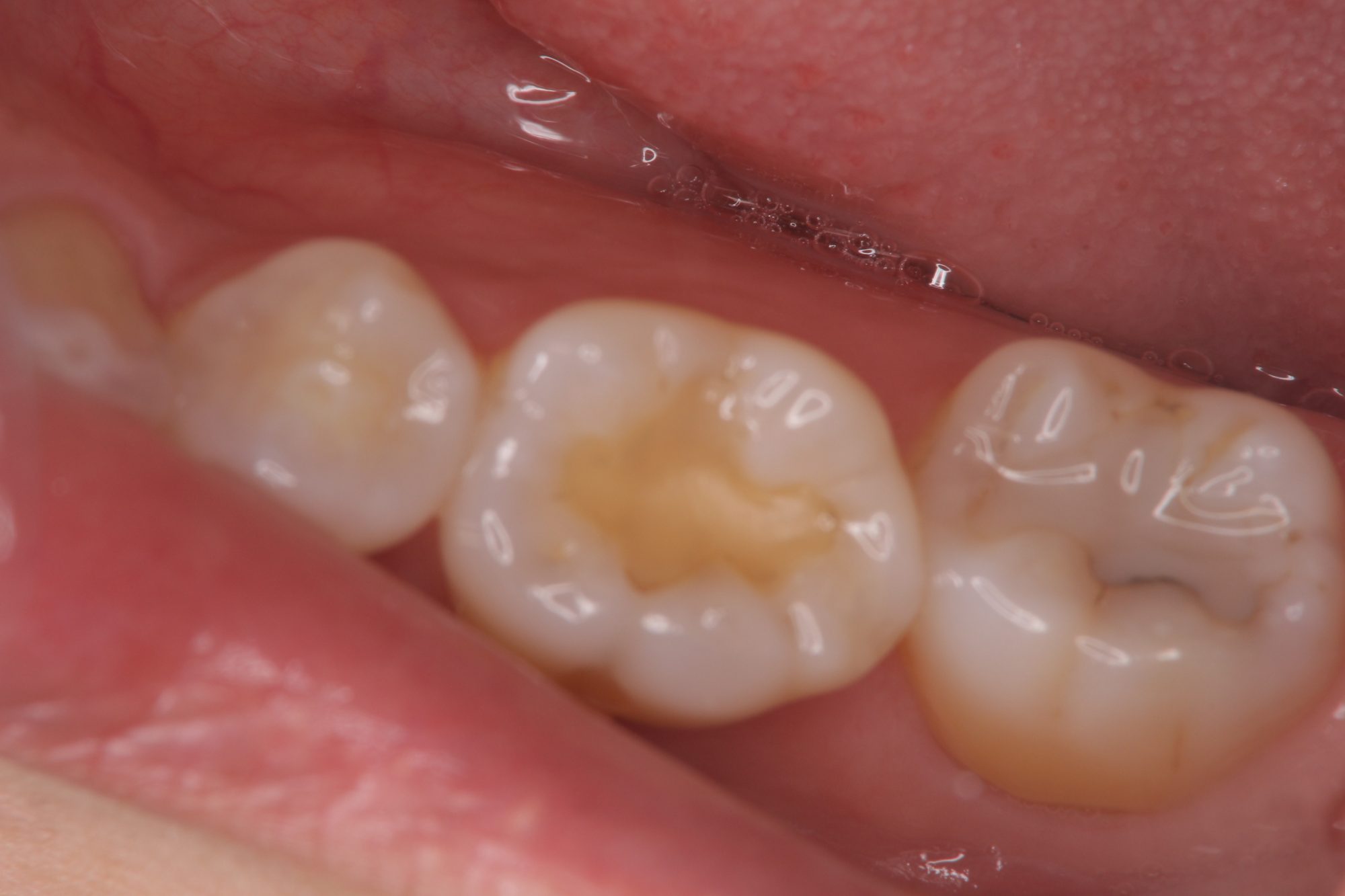 Bonding Is Good Between Friends AND Your Teeth - Hitomi Dental Office